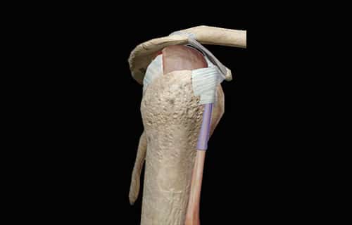 Σύνδρομο Υποκρωμιακής Προστριβής του Ώμου: Διάγνωση & Θεραπεία