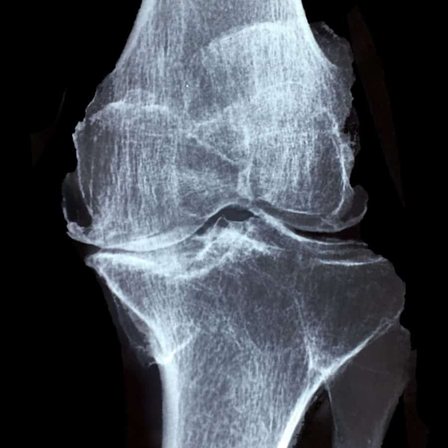 ΑΡΘΡΙΤΙΔΑ ΤΟΥ ΓΟΝΑΤΟΣ - minimalorthopedics