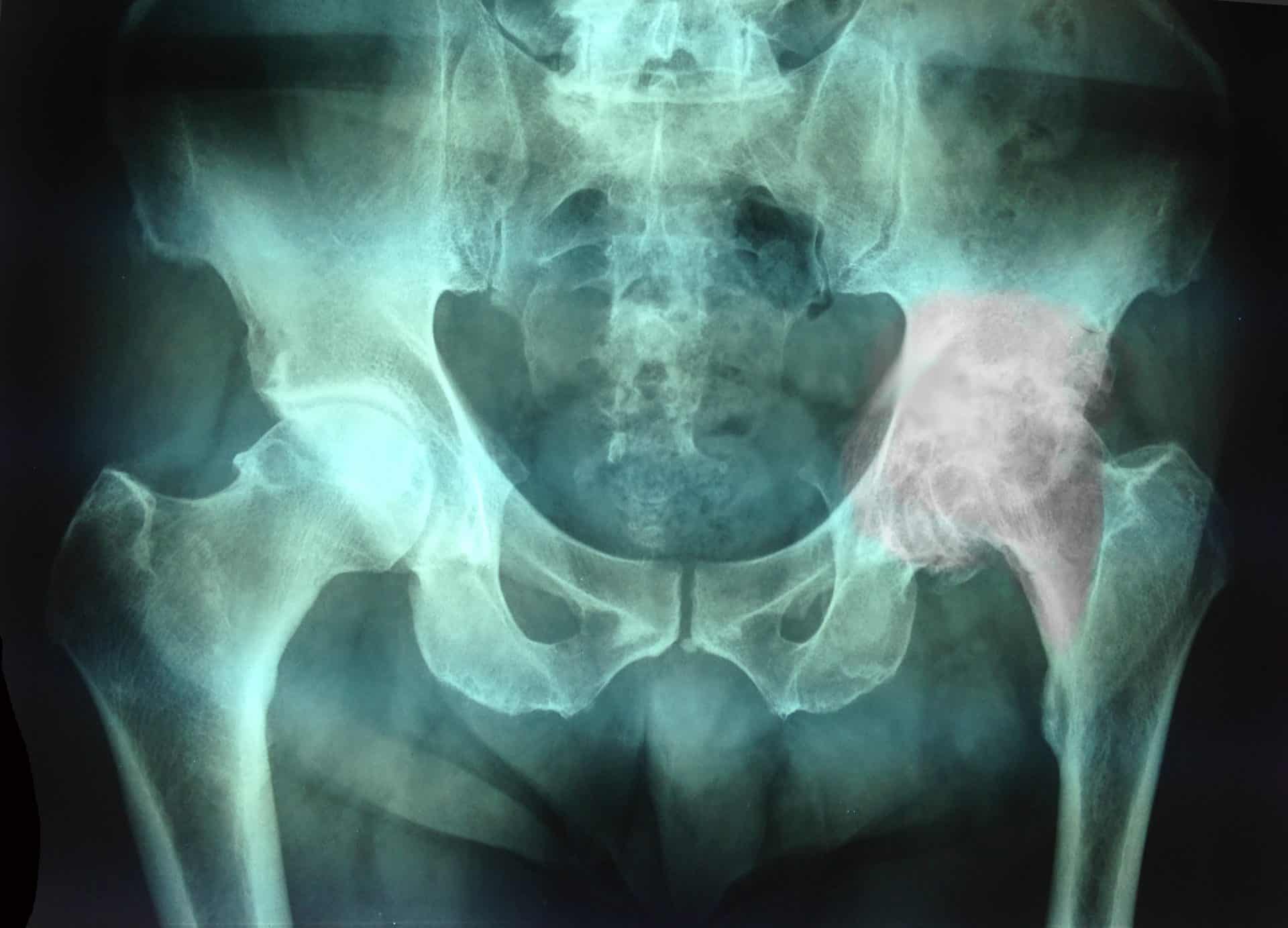 ΑΡΘΡΙΤΙΔΑ ΙΣΧΙΟΥ - minimalorthopedics