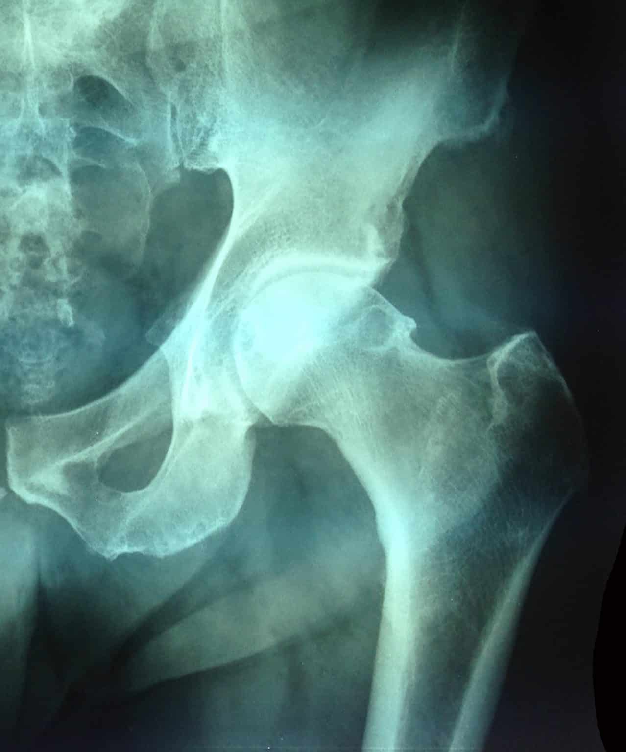 ΣΥΝΔΡΟΜΟ ΜΗΡΟΚΟΤΥΛΙΑΙΑΣ ΠΡΟΣΚΡΟΥΣΗΣ